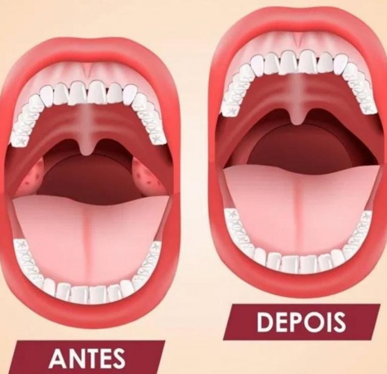 Amígdalas - Dra. Paloma Gama